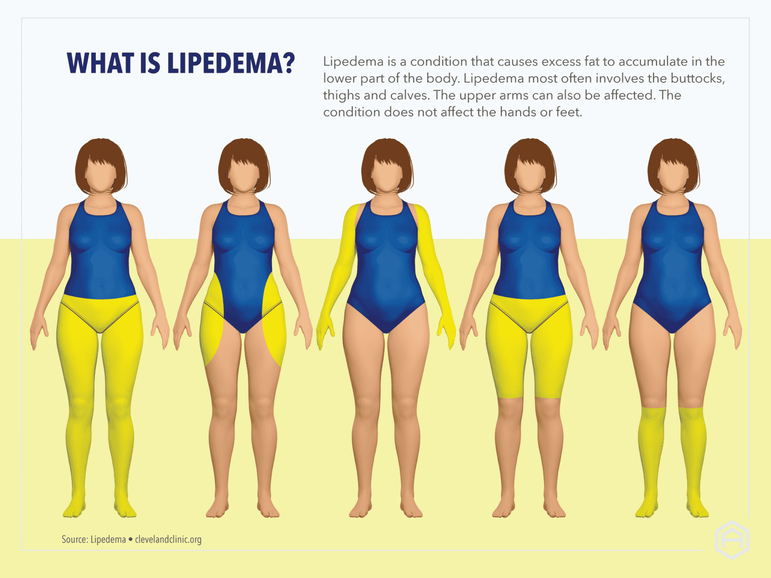Lipedema: Pain, Associated Conditions and Hope - AIROS Medical, Inc.
