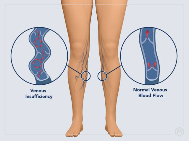 venous-blood-flow - AIROS Medical, Inc.